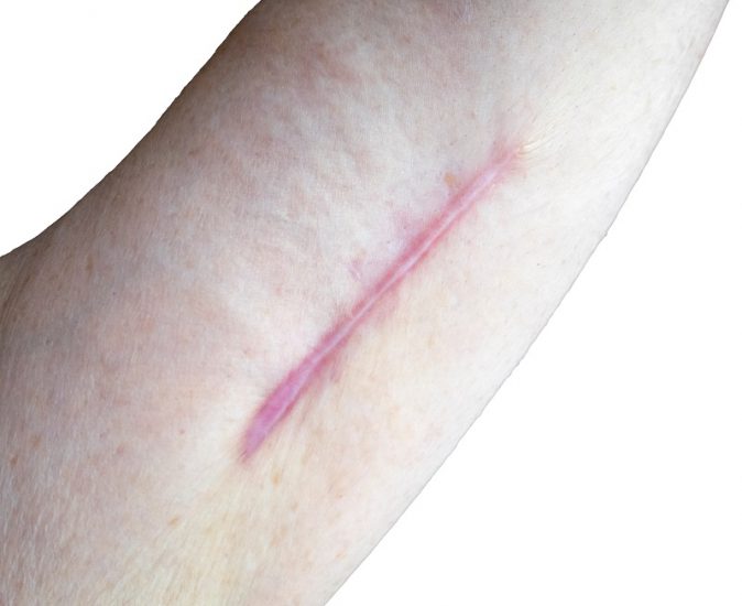 Linear hypertrophic scar - www.us.StrataTriz.com